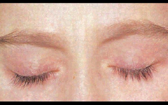 什么是皮肌炎？这种病为何如此凶险？——上海热线HOT频道